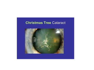 Christmas Tree Cataract Myotonic Dystrophy