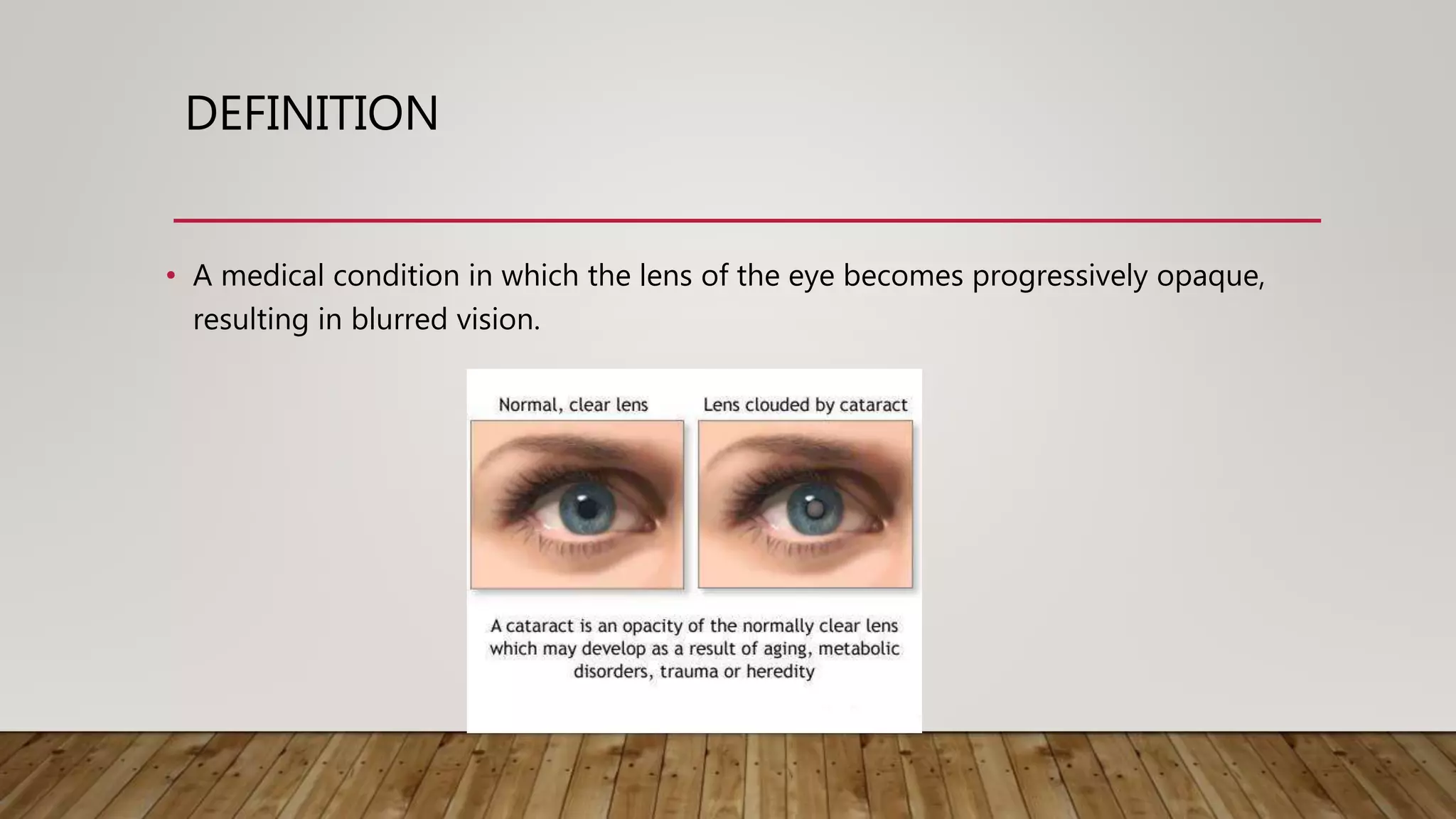 Cataract | PPTX
