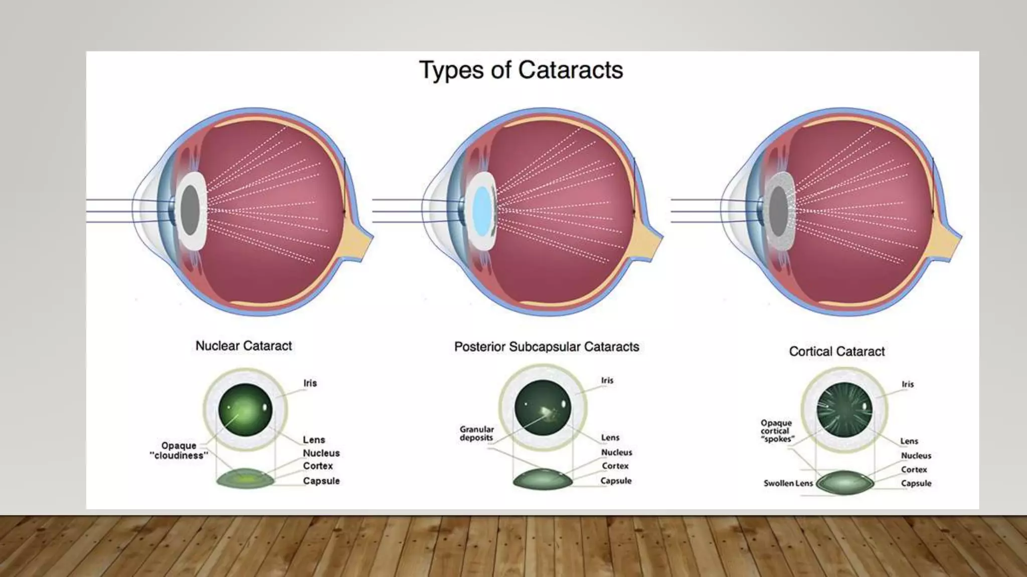 Cataract | PPT | Free Download
