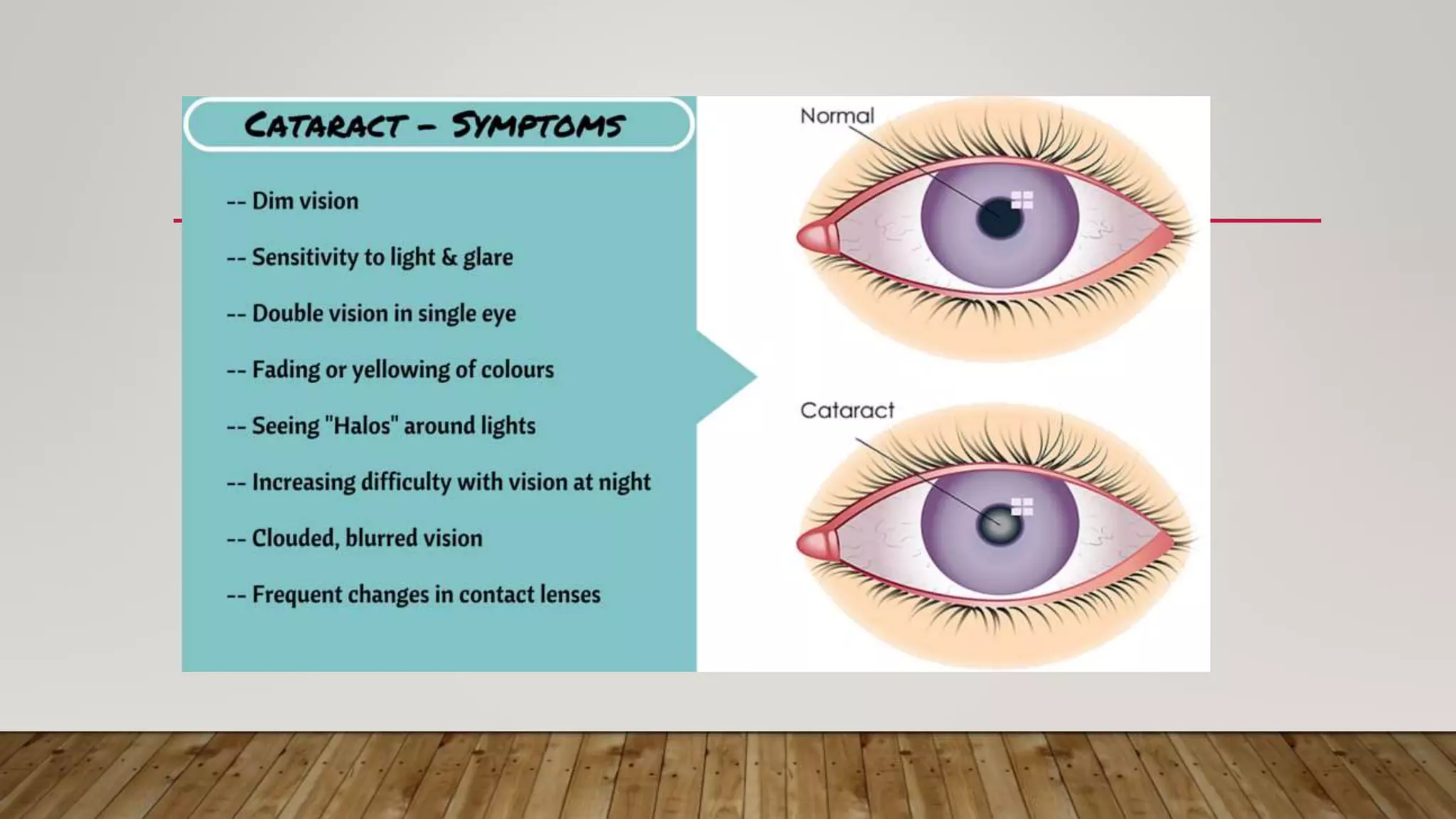 Cataract | PPTX