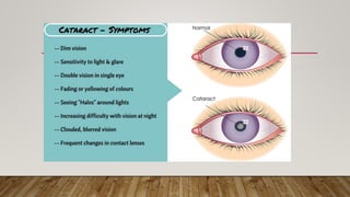 Cataract | PPT