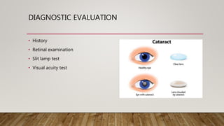 Cataract | PPTX