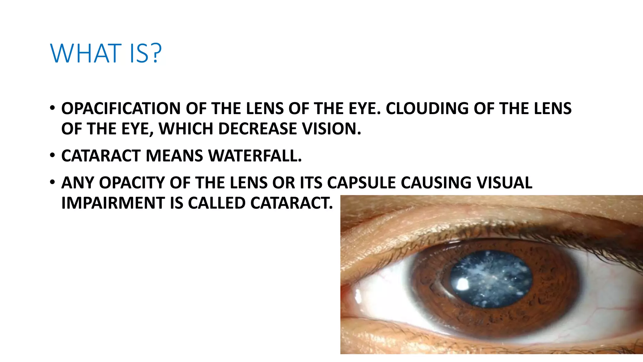 Cataract | PPT