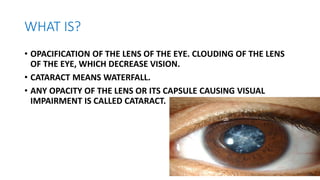 Cataract | PPTX
