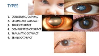 Cataract | PPTX