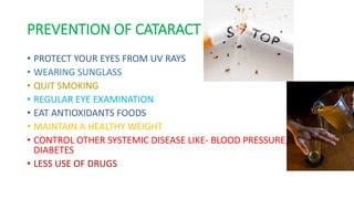 Cataract | PPTX
