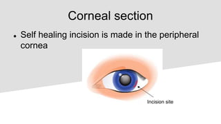 Cataract | PPT