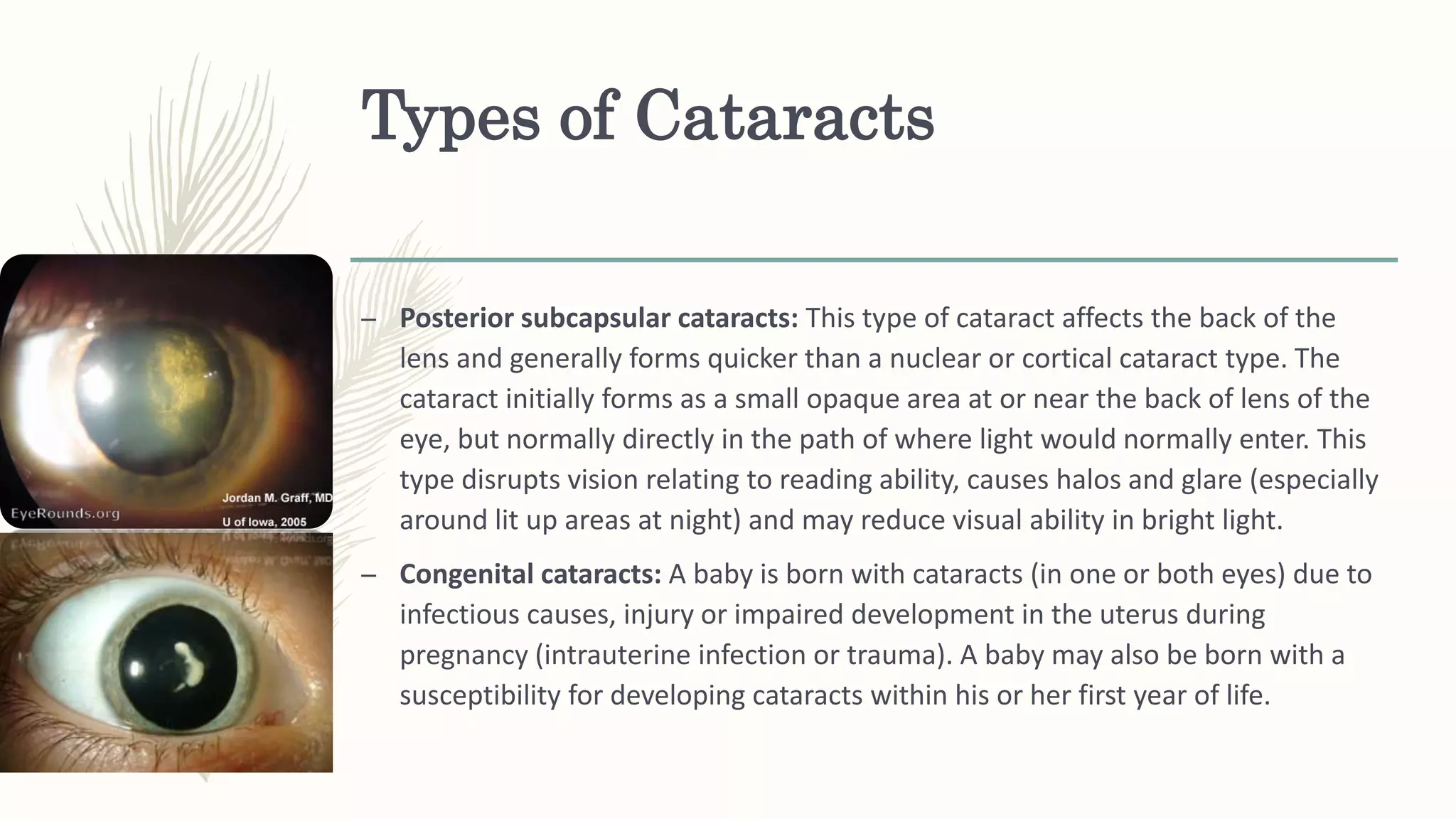 Cataract | PPT