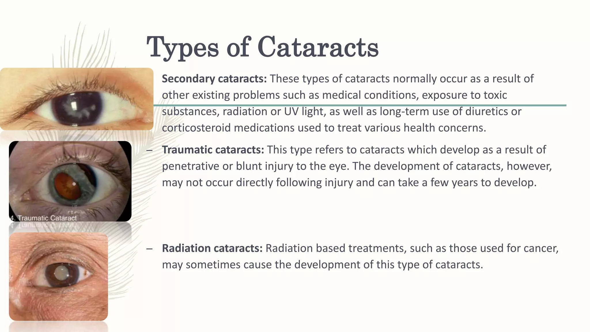 Cataract | PPT