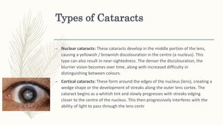 Cataract | PPTX
