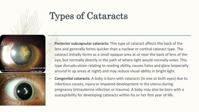 Cataract | PPT