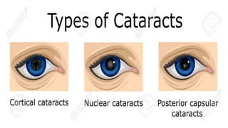 Cataract and its management | PPTX