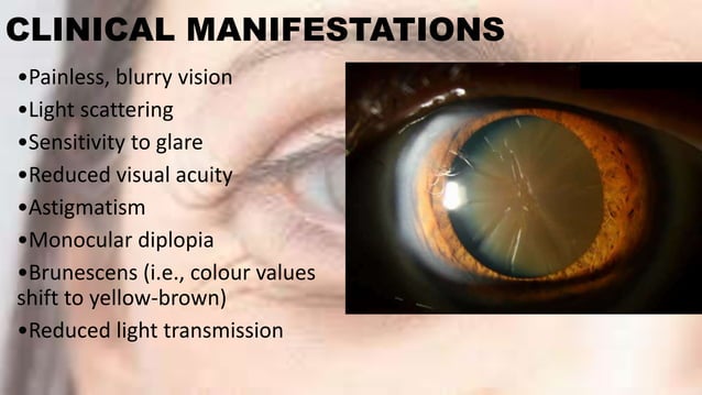 Cataract and its management | PPTX | Eye and Vision Conditions ...