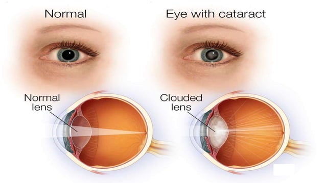 Cataract and its management | PPTX | Eye and Vision Conditions ...