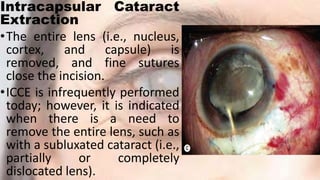 Cataract and its management | PPTX