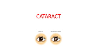 Cataract | PPTX