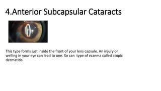 Cataract | PPTX