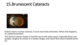 Cataract | PPTX