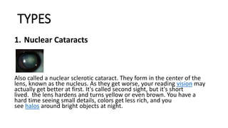 Cataract | PPTX