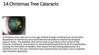 Christmas Tree Cataract Myotonic Dystrophy