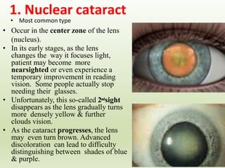 Cataract | PPT