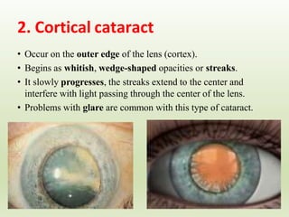 Cataract | PPT