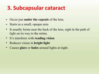 Cataract | PPT