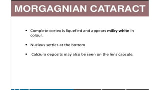 Cataract | PPT