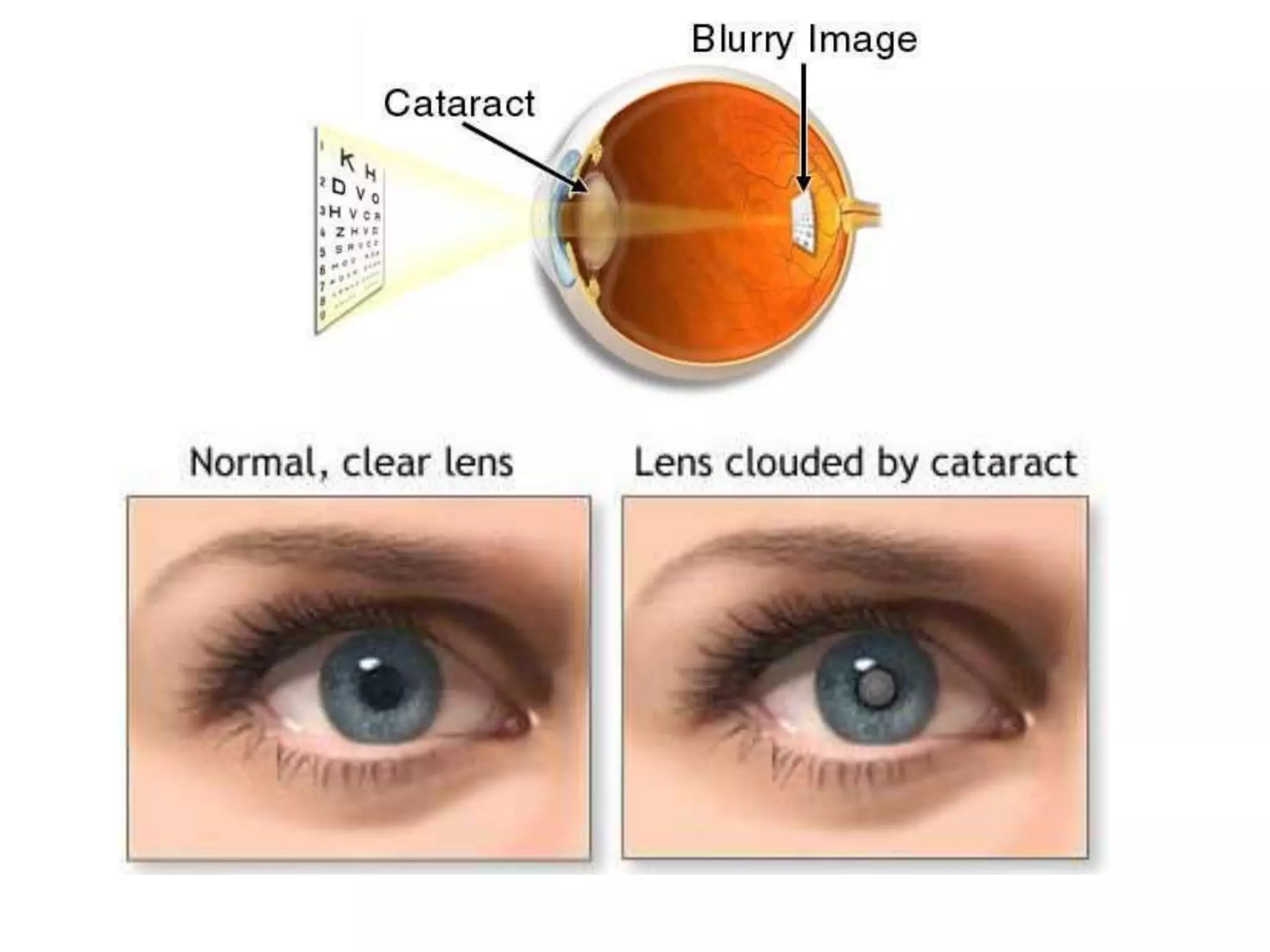 Cataract | PPTX | Eye and Vision Conditions | Diseases and Conditions
