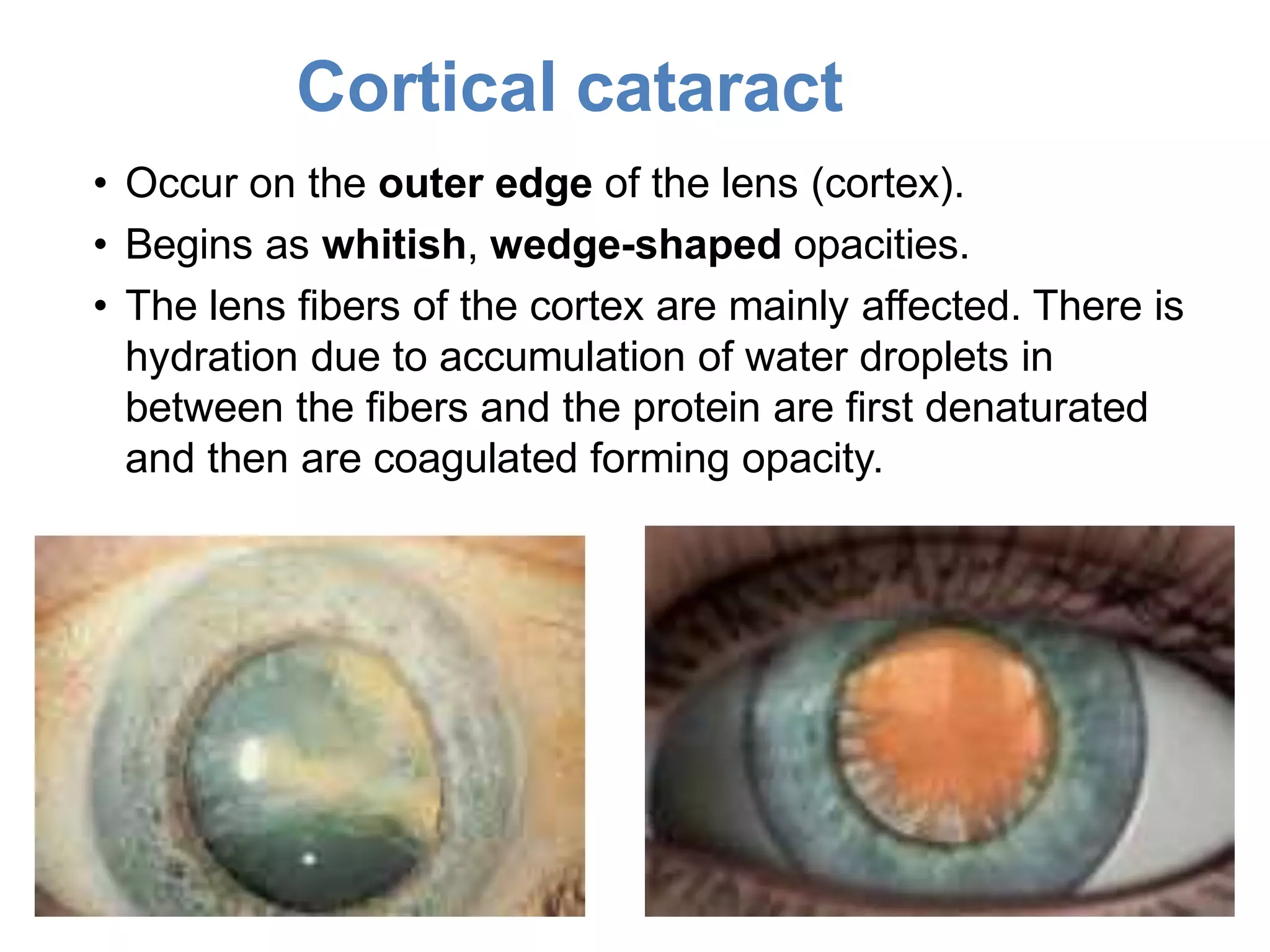 Cataract | PPTX