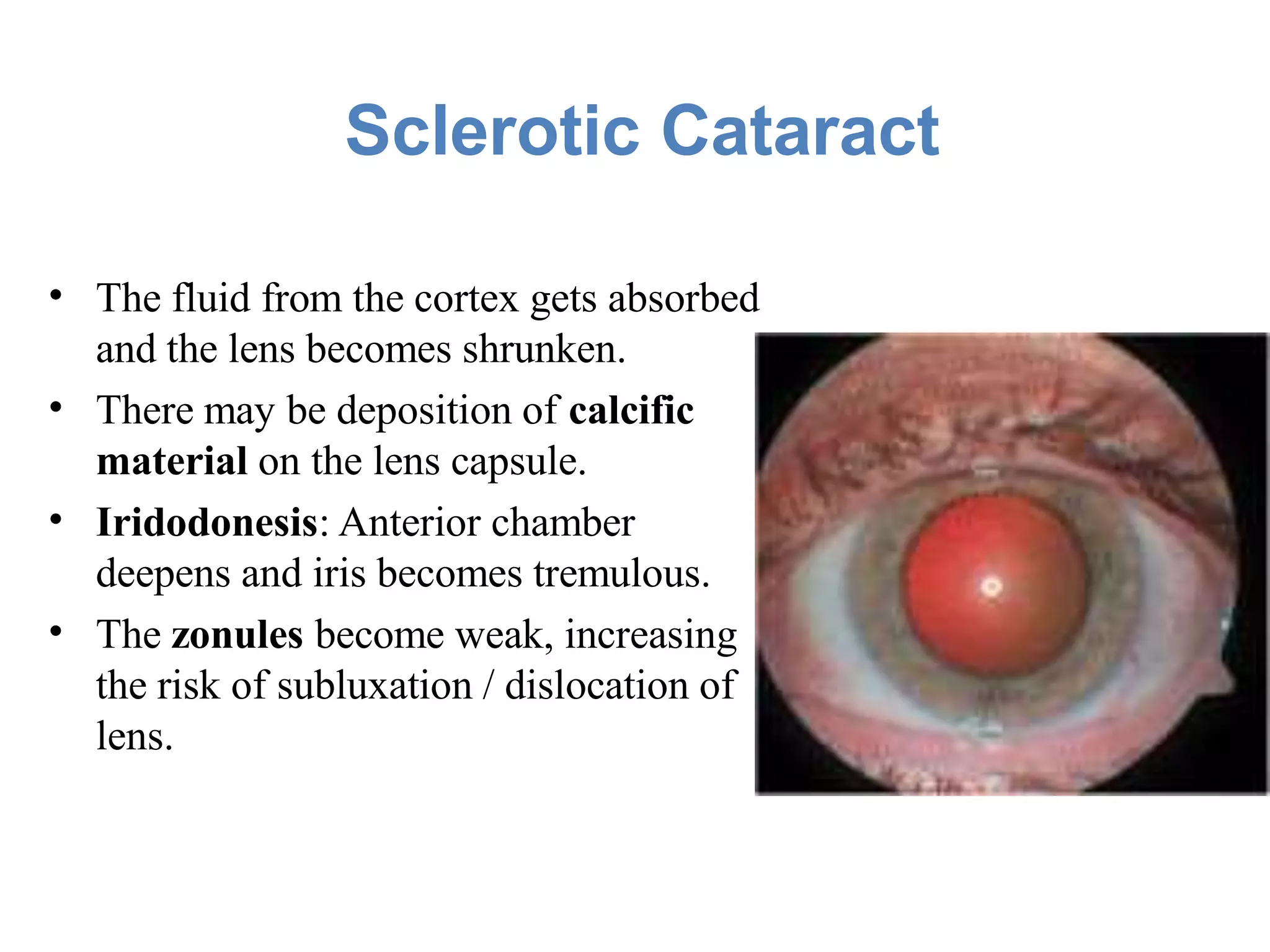 Cataract | PPTX