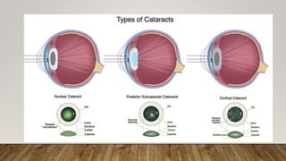 Cataract | PPTX