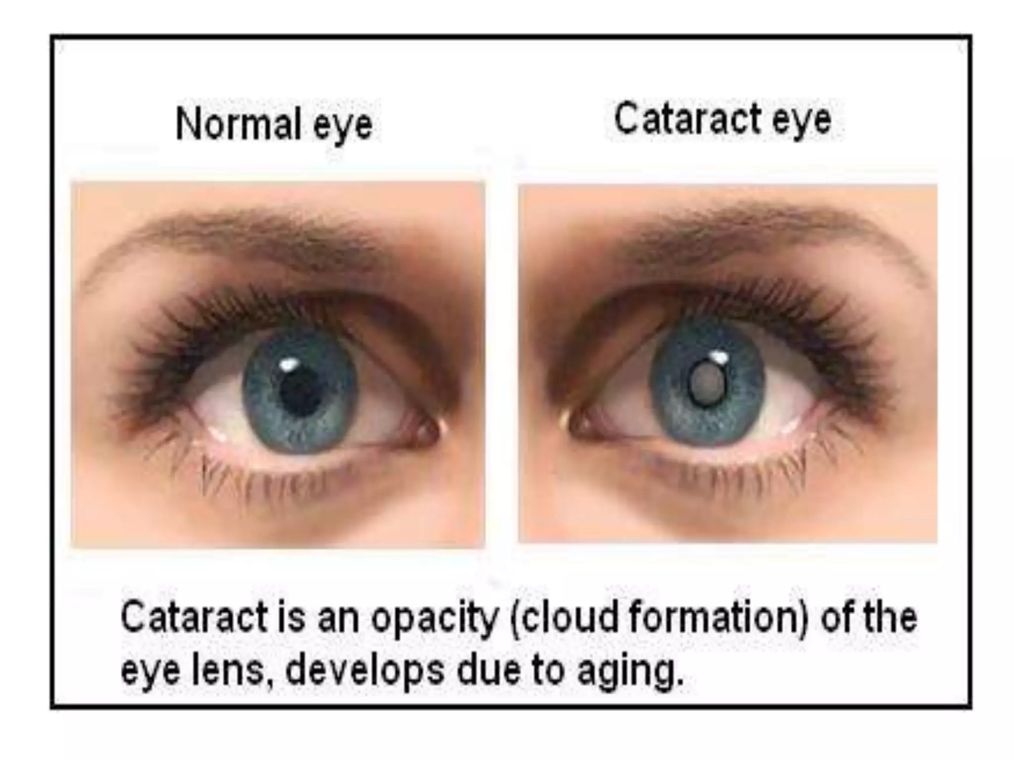 Cataract | PPTX