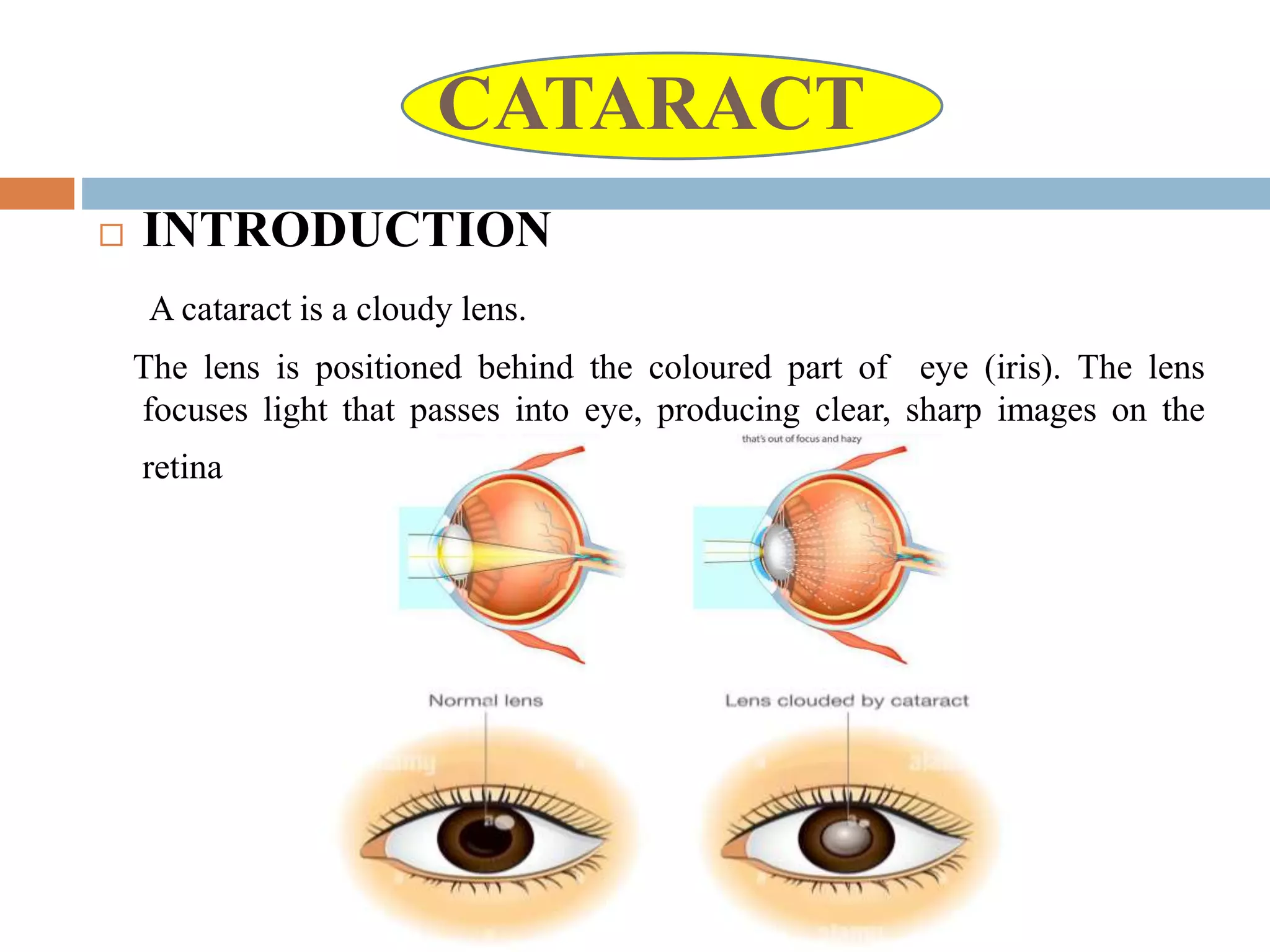 cataract.pptx