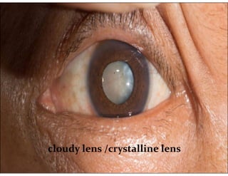 Cataract.pdf