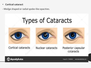 CATARACT.pptx