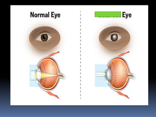cataract.pptx