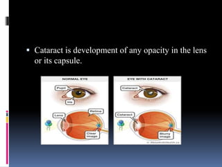 cataract.pptx