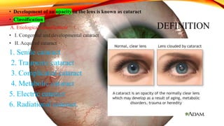 cataract.pptx