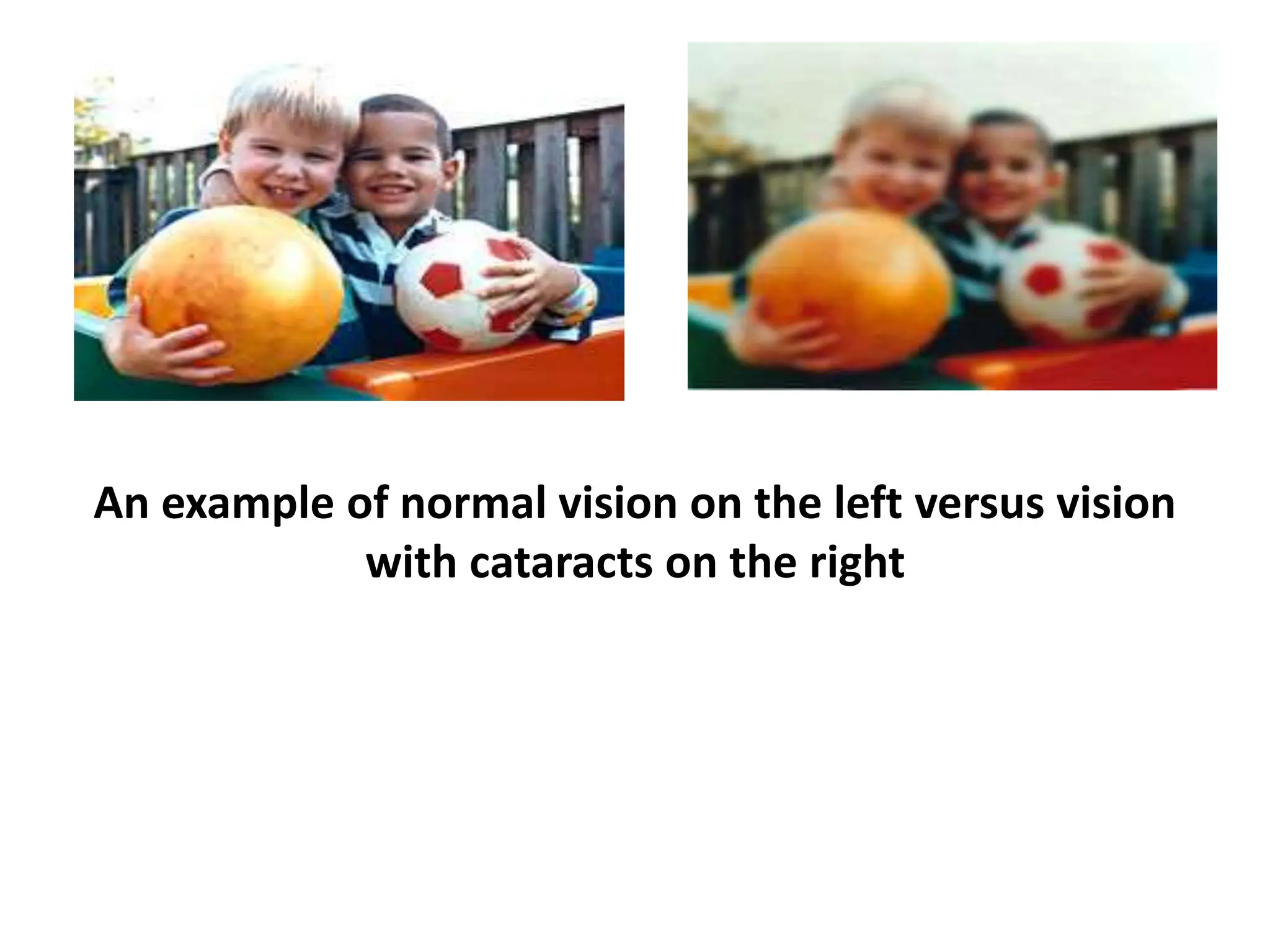 Ophthalmological disorder Cataract for B.Sc. Nursing students | PPTX