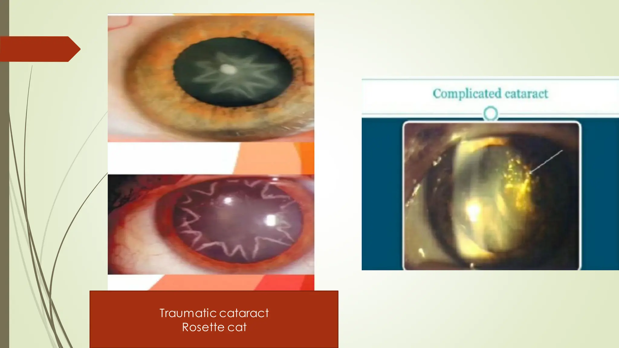 Etiological classification of cataract Dr.BKP