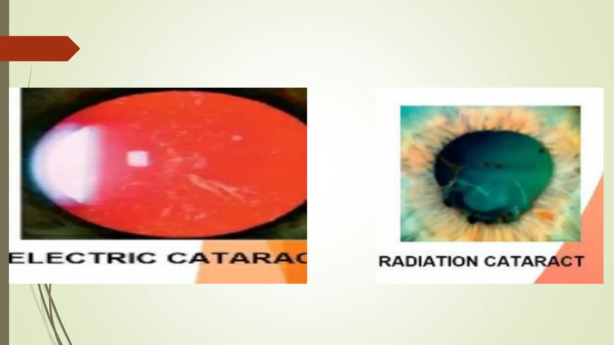 Etiological classification of cataract Dr.BKP
