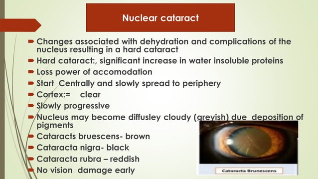 Etiological Classification Of Cataract Dr Bkp
