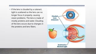 A cataract is a cloudy or opaque area in the normally clear lens of the ...