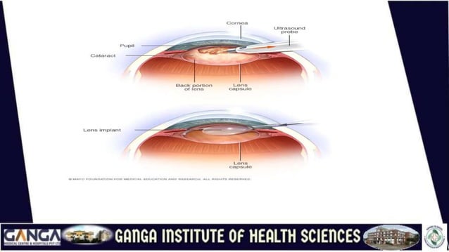 cataract and its management.pptx for nursing students | PPTX | Eye and ...