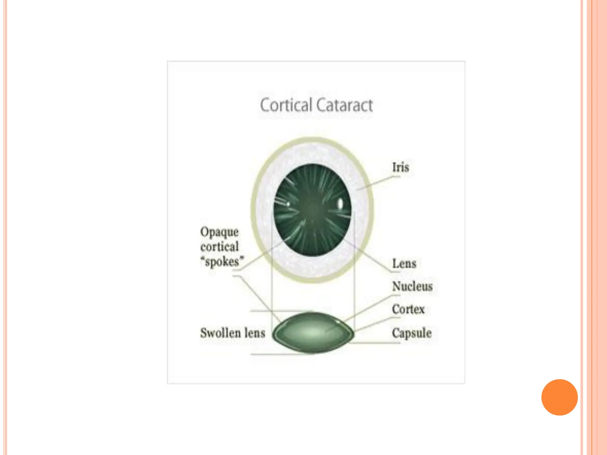 CATARACT RESEARCH WORK AND SEMINAR PRESENTATION | PPT