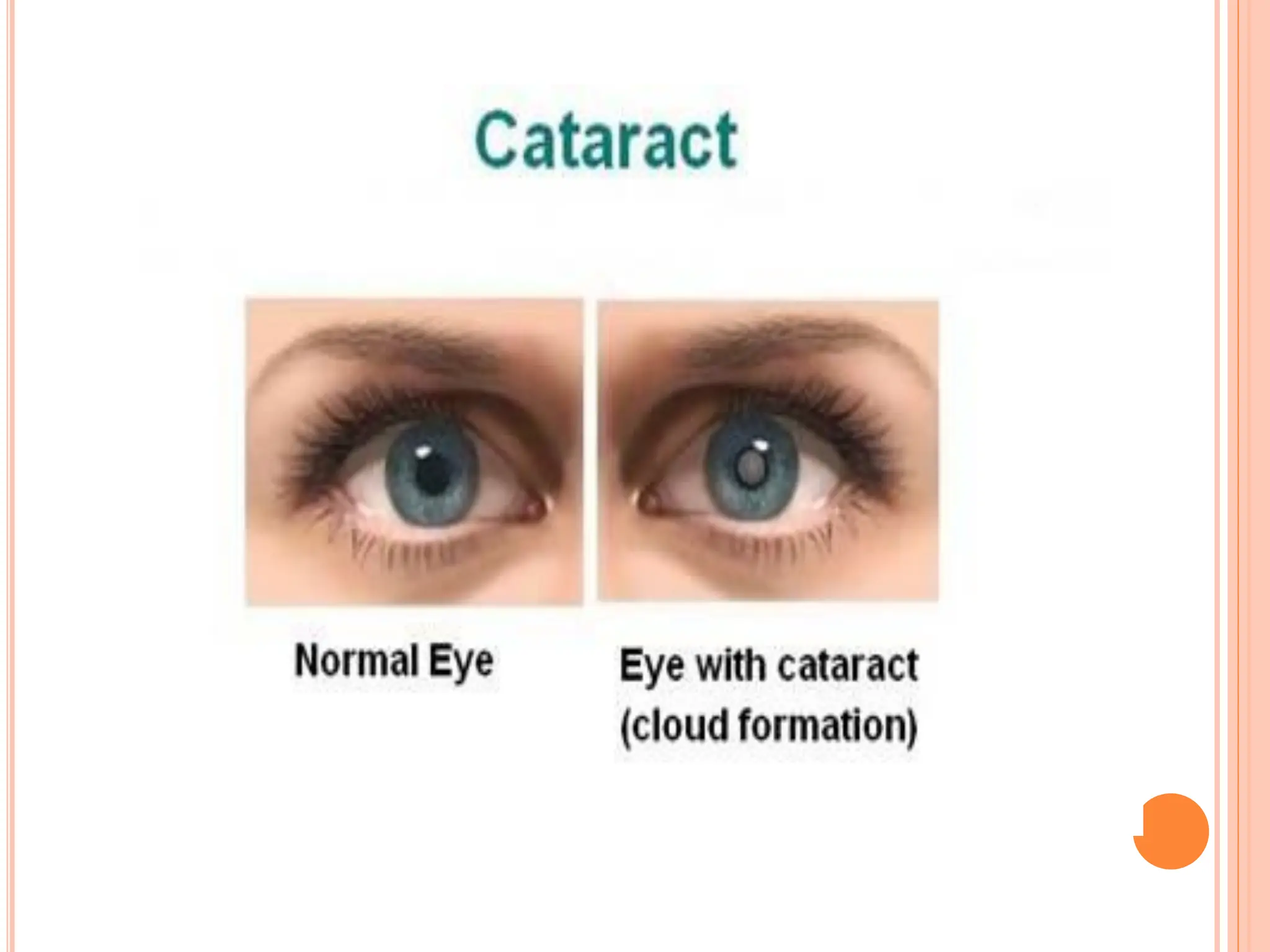 CATARACT RESEARCH WORK AND SEMINAR PRESENTATION | PPT