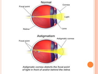 CATARACT RESEARCH WORK AND SEMINAR PRESENTATION | PDF