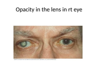 Cataract. An mbbs classroom lecture ppt pptx | PPTX