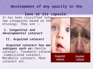 cataract.pptkhggjjyfyfyfyjfyyjfjygggguyg | PPT